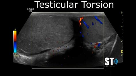 Testicular Scrotal Doppler Protocol Sonographic Tendencies