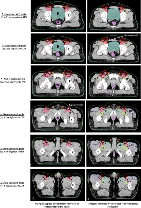 Recommendations And Clinical Validation Of Inguinal Clinical Target