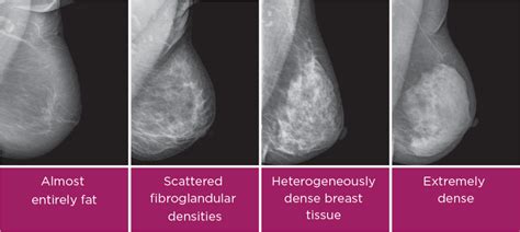 Breast Density Understanding Its Significance And Impact On Breast