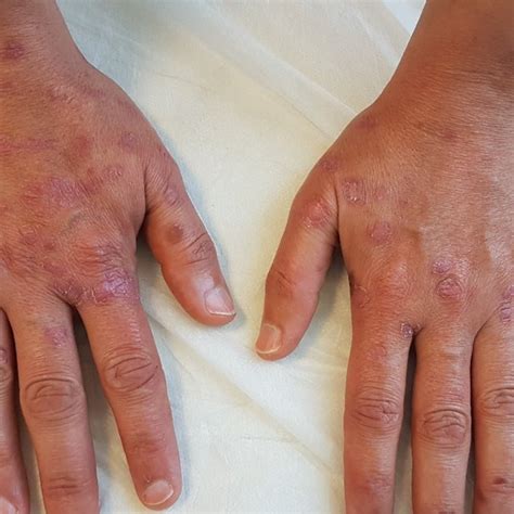 Erythematous Targetoid Lesions Distributed Over The Palmar Surfaces