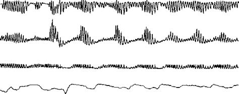 [pdf] The Apnea Ecg Database Semantic Scholar