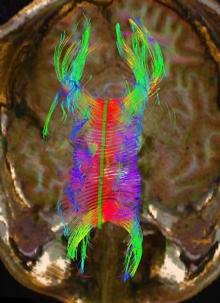 [figure Dti Of Corpus Callosum Contributed By Sunil Munakomi Md