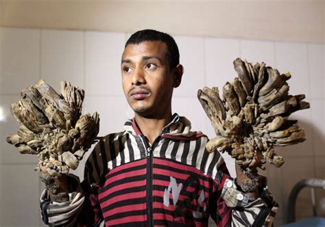 Bangladeshi Tree Man Successfully Operated Of Condition That Turned His
