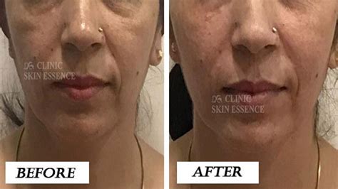 Dermal Filler Treatment Cost In Delhi Patel Nagar Dermal Fillers In