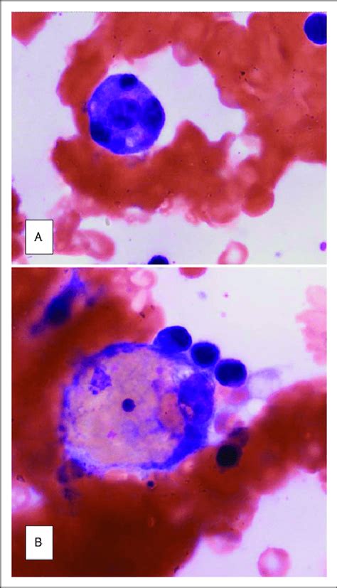 Bone Marrow Core Biopsy And Aspirate A B Bone Marrow Core Biopsy