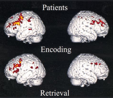 Statistical Parametric Maps Of Mean Activation During The Encoding And