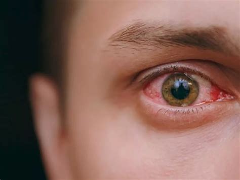 Conjuntivitis Qué Es Causas Síntomas E Información