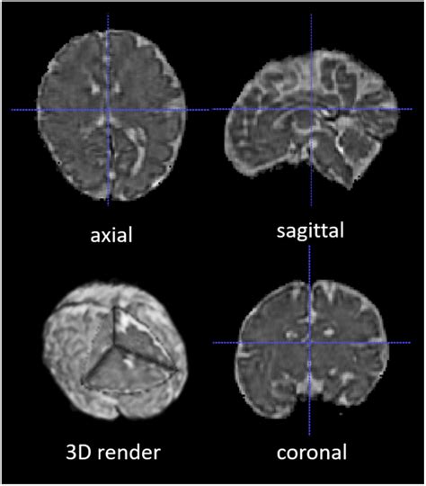 Frontiers Semi Automatic Segmentation Of The Fetal Brain From