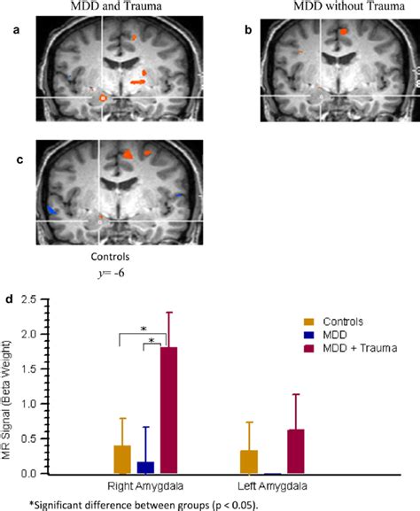 Group Differences In Bilateral Amygdala A Mdd With A Signi Fi Cant