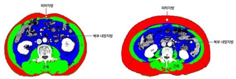 비만의 역설 내장·피하지방 많으면 대장암 재발 위험성↓ 파이낸셜뉴스