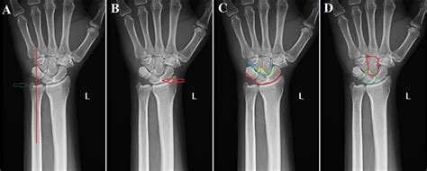 Isolated Lunate Dislocation Bmj Case Reports