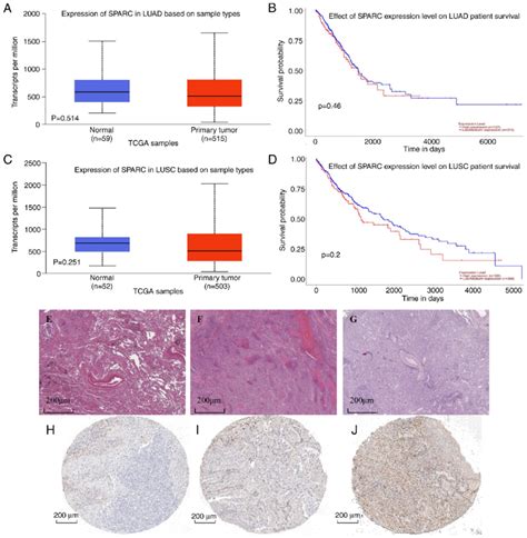 A D Analysis In The Ualcan Database A Expression Of Sparc Gene In