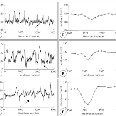 A B C Sample Heart Rate Time Series Of A Normal Fetus A A Fetus