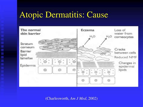 Ppt Atopic Dermatitis Powerpoint Presentation Free Download Id 4929119