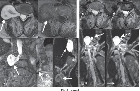 Figure 1 From Surgery For Lumbar Radiculopathy Due To Intervertebral