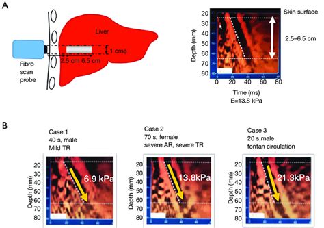 Liver Stiffness By Fibroscan ® A Panels Show How To Measure Liver