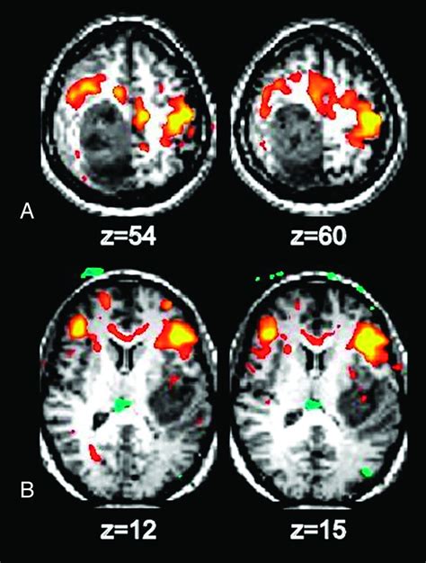 Resting State Fmri A Review Of Methods And Clinical Applications