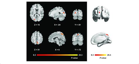 Brain Regions With Significant Alff Difference Among Active Tao