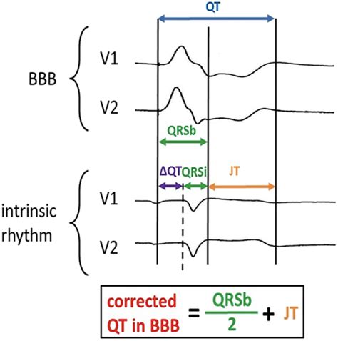 Qtc Interval Evaluation In Patients With Right Bundle Branch Block O