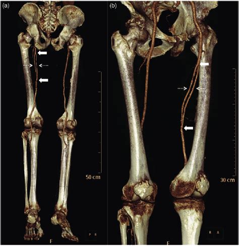 Three Dimensional Volume Rendered Ct Images A B Showed A Single
