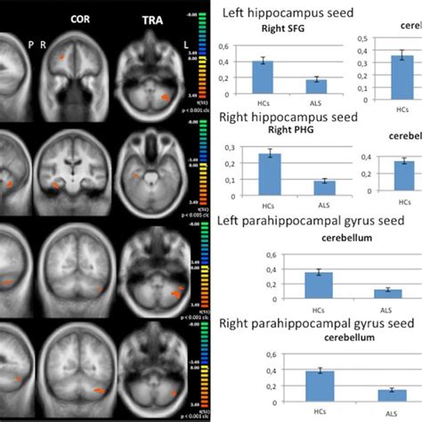 Seed Based Connectivity Analysis Decreased Functional Connectivity