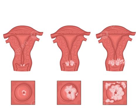 Illustration Of Cervical Dysplasia Abnormal Stages Uterine Vector