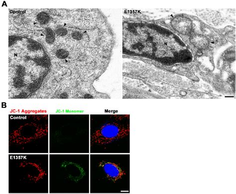 Abnormalities In Mitochondrial Ultrastructure And Function In Als