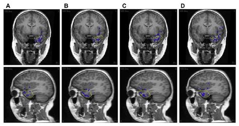 The Source Location Of All Interictal Spikes In Patient 3 Obtained