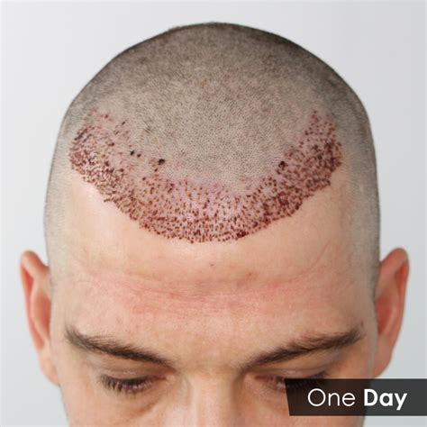 Hair Transplant Recovery Post Surgery Recovery Timeline