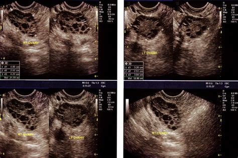 7 signs you might have polycystic ovarian syndrome queensland health