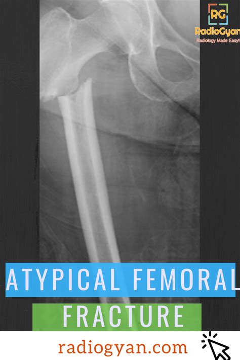 Atypical Femoral Fracture Radiology Case Radiology