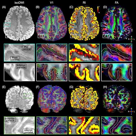 Column Based Cortical Depth Analysis Of The Diffusion Anisotropy And