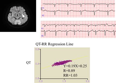 Figure1 Representative Qt Rr Relationship In A 65 Year Old Woman With
