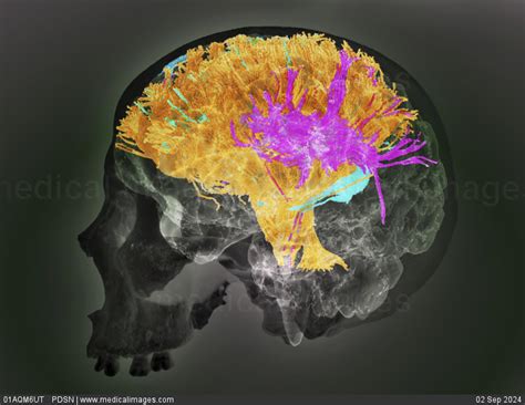 Stock Image 3d Diffusion Tensor Imaging Dti Of The Brain Tractography