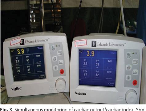 Figure 1 From Continuous Cardiac Output Measurement During Off Pump