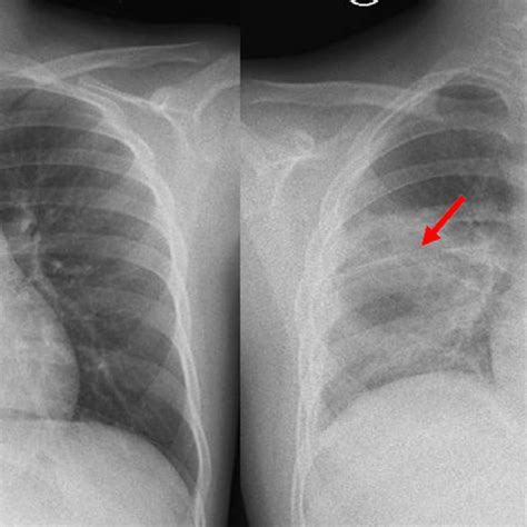 Follow Up Chest Radiographs At 14th Day A And H 36th Day B After