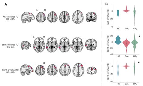 Alterations In Net And Sert Enriched Functional Connectivity Fc In