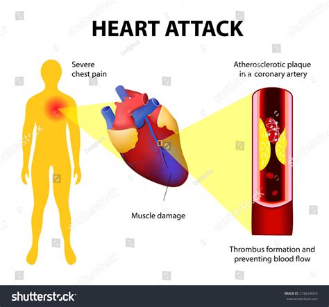 Anatomy Of A Heart Attack Diagram Of A Myocardial Infarction