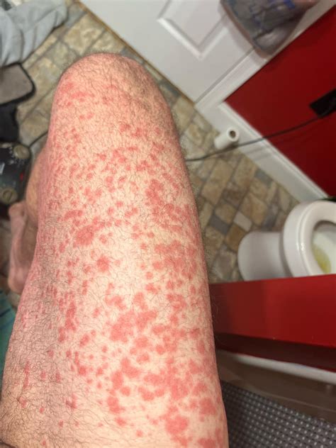 Had Psoriasis On One Of My Nipple For About 3 4 Months And This Finally