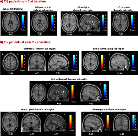 Sub Regional Left Thalamic Resting State Functional Connectivity