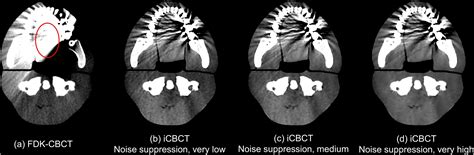 Metal Artifact Reduction Using Iterative Cbct Reconstruction Algorithm