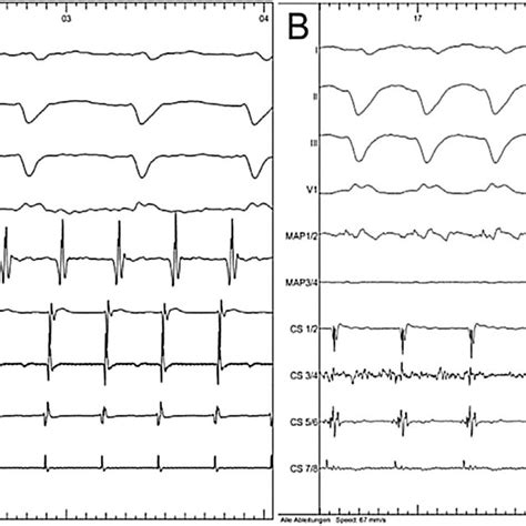 A Intracardiac Ecg Demonstrates Atrial Flutter With 2 1 Conduction