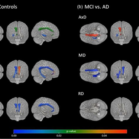 Significant Differences In Diffusion Tensor Imaging Dti Metrics