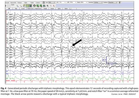 Normal Versus Abnormal Eeg