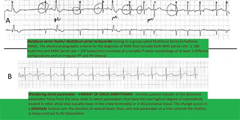 Atrial Flutter Ecg Review Criteria And Examples