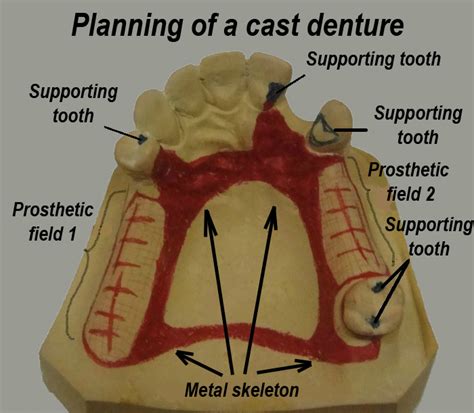 Components Of Partial Denture