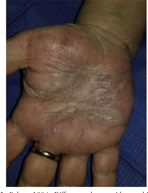 Figure 1 From Palmar Lichen Sclerosus Et Atrophicus Semantic Scholar