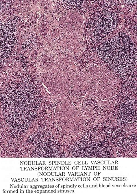 pathology outlines vascular transformation of sinuses