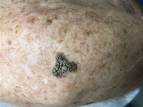Seborrheic Keratoses Stock Image C043 4314 Science Photo Library