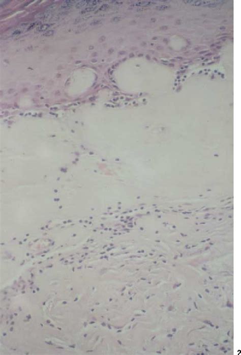 Figure 1 From Localized Lichen Sclerosus Et Atrophicus Of The Finger